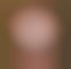 Subdermal Implants: Customize Your Flesh with Body Modifications