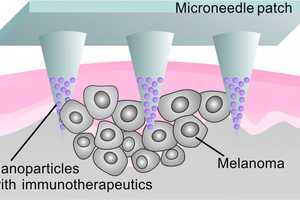 Tumor-Neutralizing Patches : microneedle patch