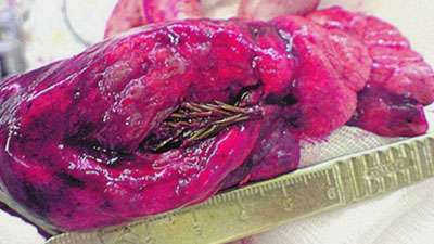Inhaled Forestation: Real Tree Found Growing in Russian Man's Lung