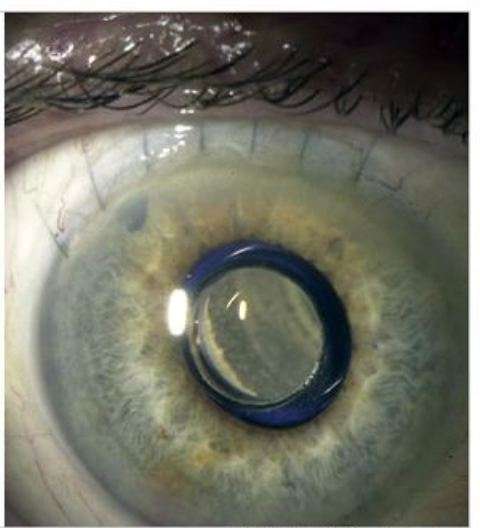 Telescopic Eyeball Implants : telescope implant